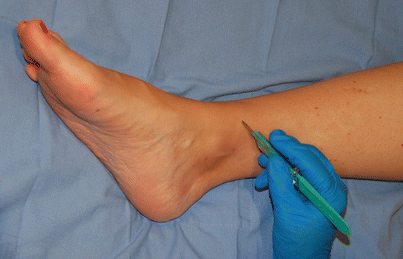 Peripheral Venous Cutdown | SpringerLink