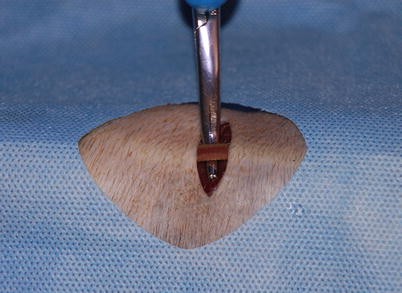 Peripheral Venous Cutdown | SpringerLink