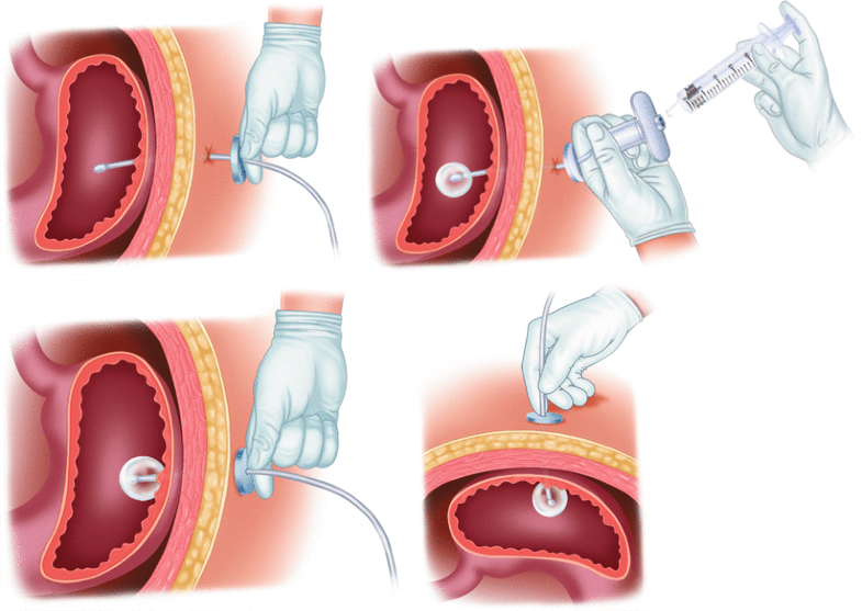 Gastrostomy Tube Placement SpringerLink Gastrostomy Tube Placement SpringerLink