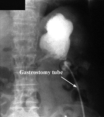 Gastrostomy Tube Placement | SpringerLink