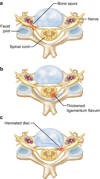 Neurovascular Disorders | SpringerLink