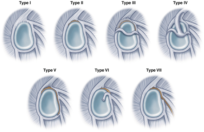 Disorders of the Long Head of the Biceps Tendon | SpringerLink
