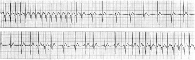 Sick Sinus Syndrome | SpringerLink