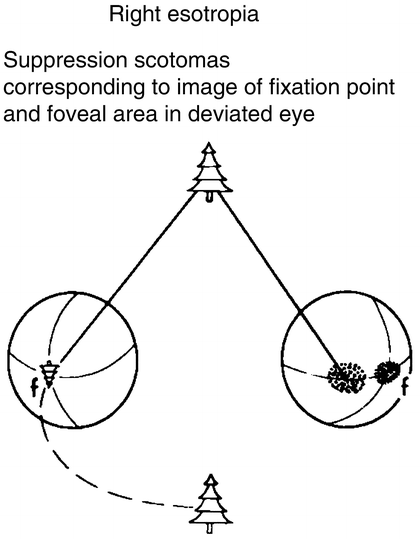 Sensorial Adaptations to Strabismus | SpringerLink