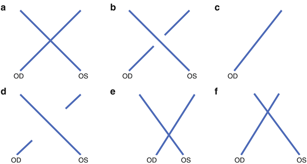 Sensorial Adaptations to Strabismus | SpringerLink