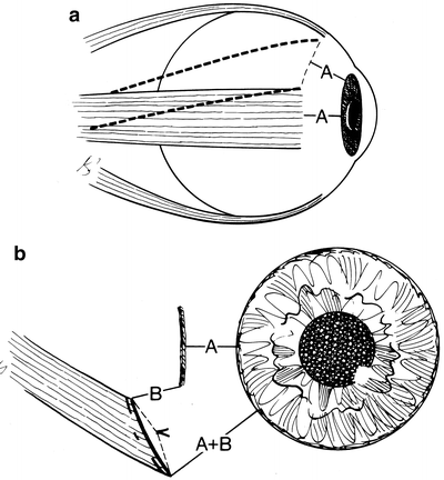A- and V-Pattern Strabismus | SpringerLink
