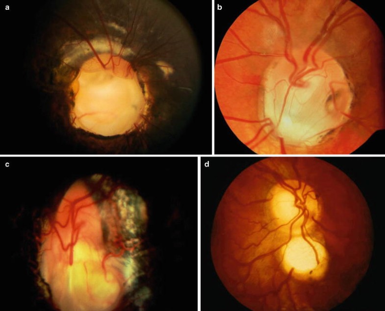 Congenital Optic Nerve Anomalies | SpringerLink
