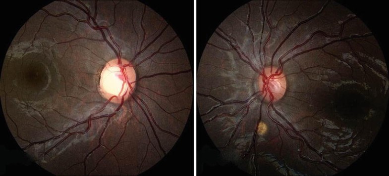 Congenital Optic Nerve Anomalies | SpringerLink