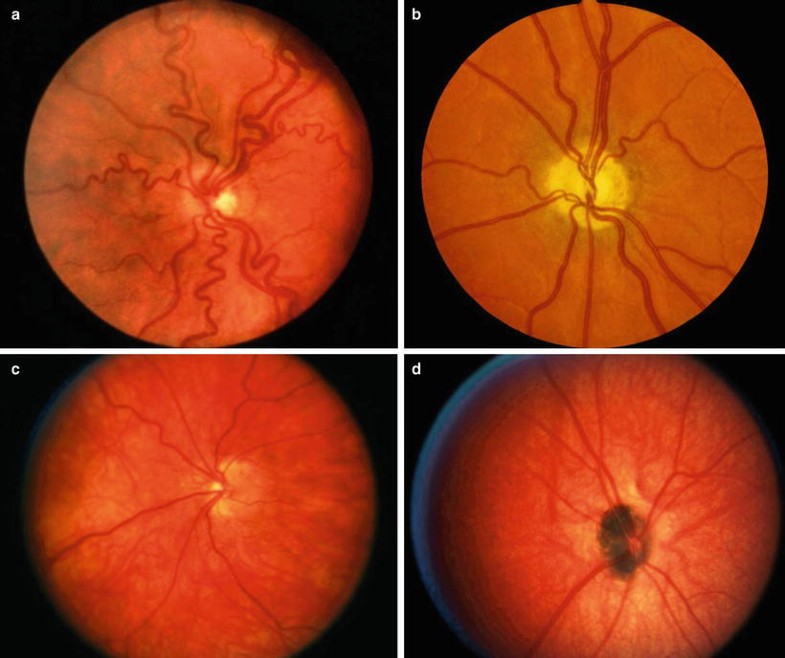 Congenital Optic Nerve Anomalies | SpringerLink