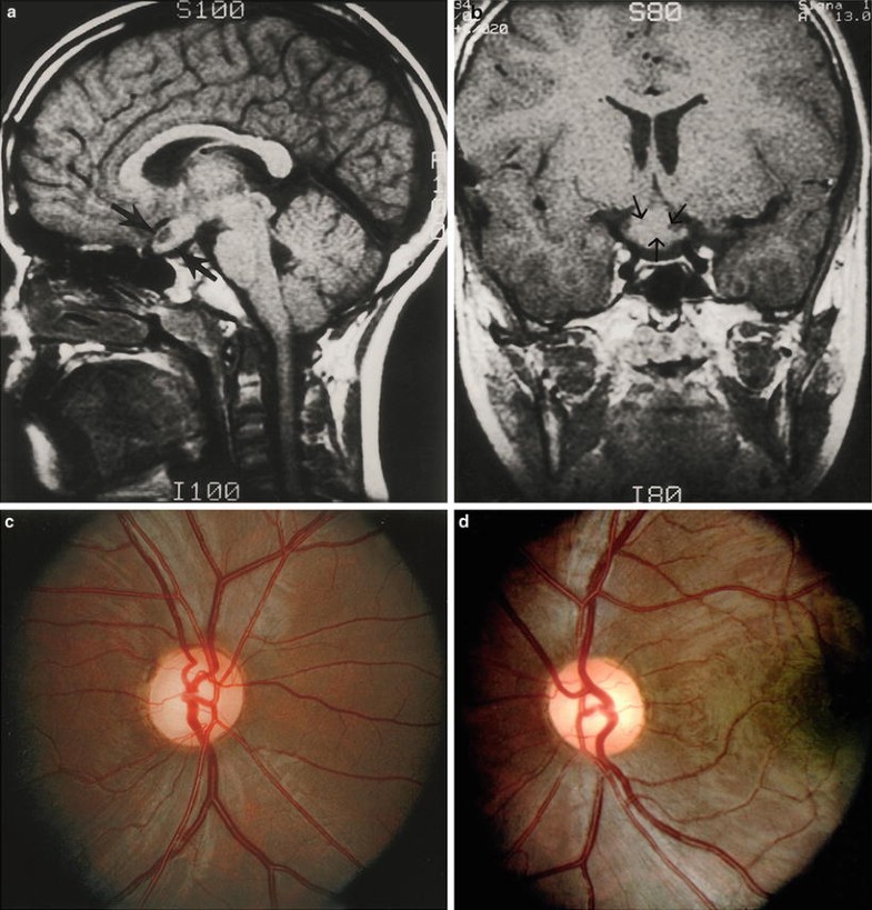 Optic Atrophy in Children | SpringerLink
