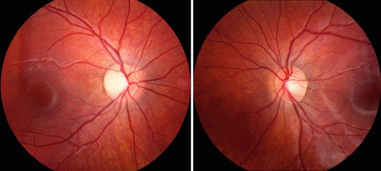 Optic Atrophy in Children | SpringerLink