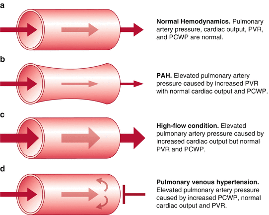 Portopulmonary Hypertension and Hepatopulmonary Syndrome | SpringerLink