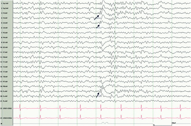 Normal EEG Variants and Artifacts | SpringerLink