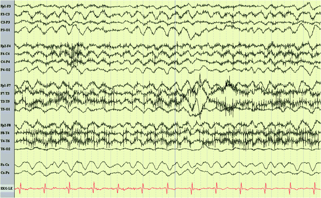 Normal EEG Variants and Artifacts | SpringerLink