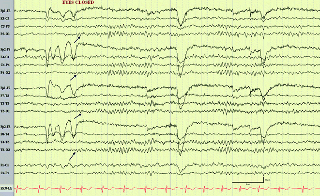 Normal EEG Variants and Artifacts | SpringerLink