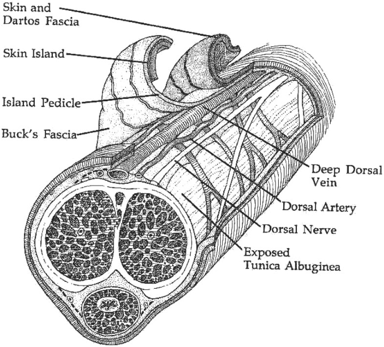 Penile Skin Flaps for Urethral Reconstruction | SpringerLink