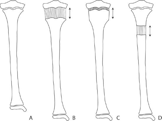 Distraction Osteogenesis of the Orthopedic Skeleton: Basic Principles ...