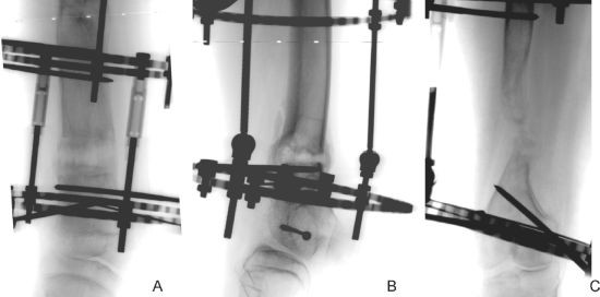 Distraction Osteogenesis of the Orthopedic Skeleton: Basic Principles ...