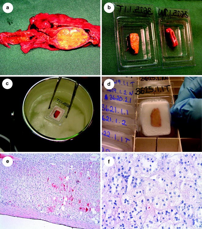 Biobanking of Fresh Frozen Tissue from Clinical Surgical Specimens ...