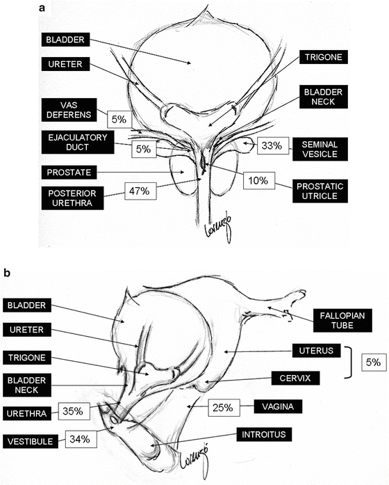 Ectopic Ureter | SpringerLink