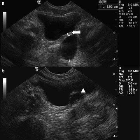Ectopic Ureter | SpringerLink
