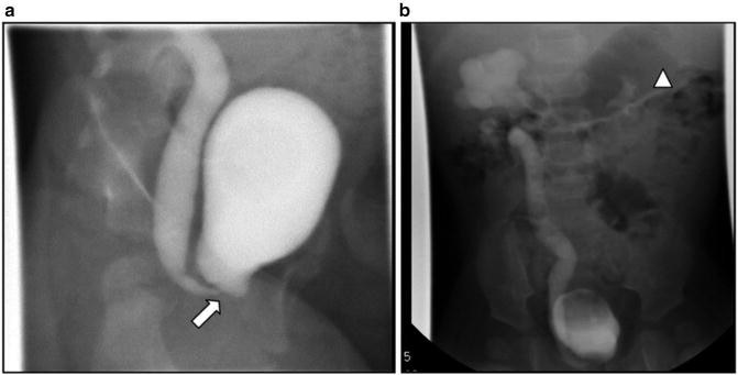Ectopic Ureter | SpringerLink