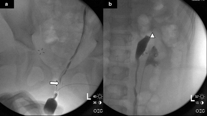 Ectopic Ureter | SpringerLink