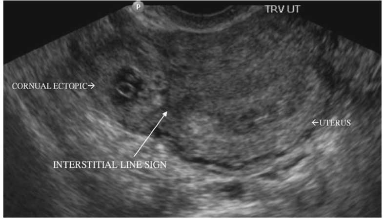 Ectopic Pregnancy | SpringerLink