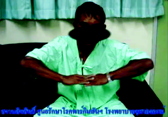 Wilson’s Disease with Wing-Beating Tremor | SpringerLink