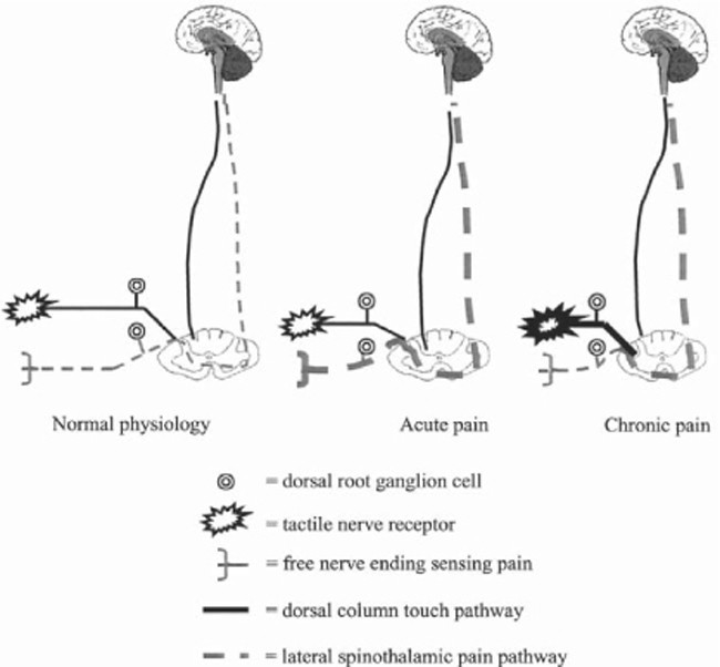 Physiology of Chronic Pain | SpringerLink