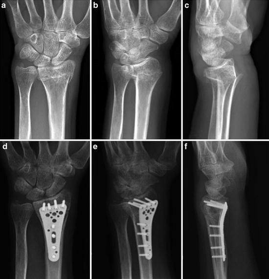 Hand and Wrist Fractures in the Elderly | SpringerLink