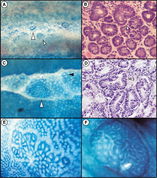 Aberrant Crypt Foci in Colon Cancer Epidemiology | SpringerLink
