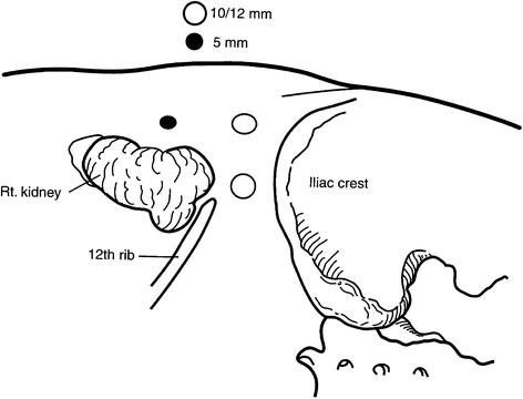Laparoscopic Renal Cyst Decortication | SpringerLink