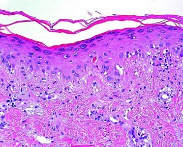 Interface Dermatitis | SpringerLink