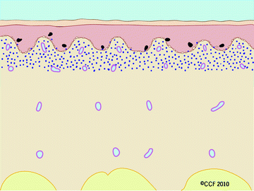 Interface Dermatitis | SpringerLink