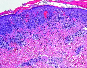 Interface Dermatitis | SpringerLink