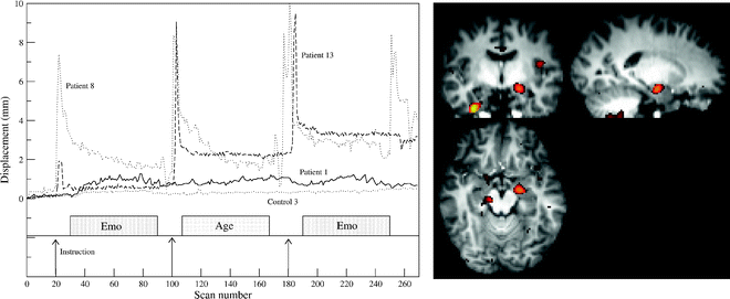 fMRI of Emotion | SpringerLink