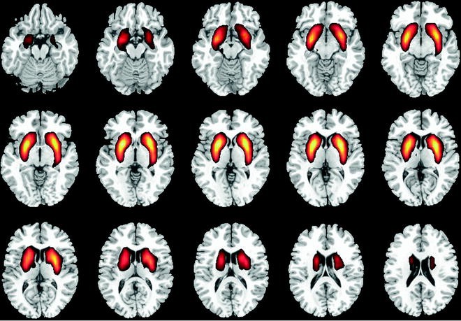 fMRI of Emotion | SpringerLink