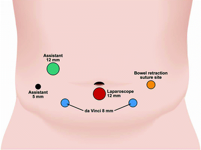 Robot-Assisted Laparoscopic Sacrocolpopexy | SpringerLink