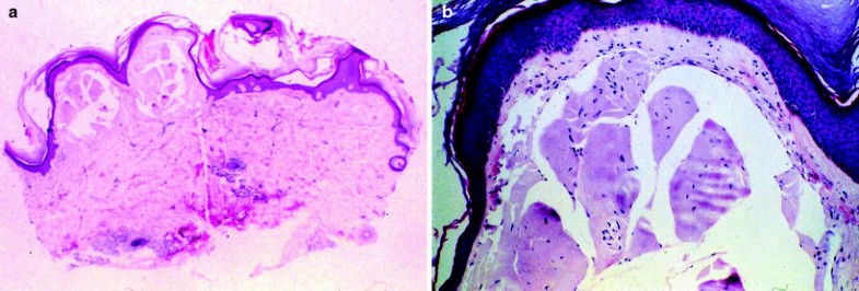 Colloid Milium | SpringerLink