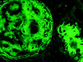 Thioflavin T Stain: An Easier and More Sensitive Method for Amyloid ...