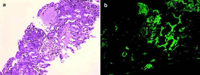 Thioflavin T Stain: An Easier and More Sensitive Method for Amyloid ...