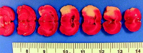 Infarct Measurement in Focal Cerebral Ischemia: TTC Staining | SpringerLink