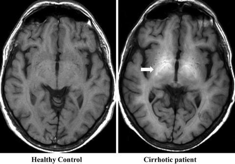 Brain Imaging in Hepatic Encephalopathy | SpringerLink
