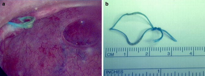 Retropubic Bladder Neck Suspensions | SpringerLink