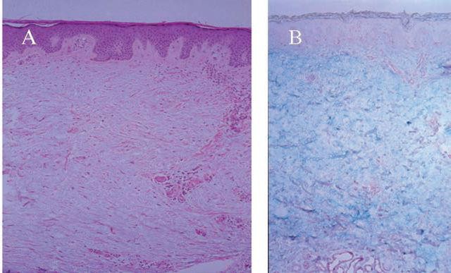 Pretibial Myxedema (Thyroid Dermopathy) | SpringerLink