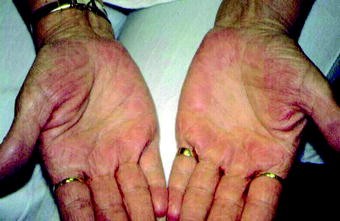 Cutaneous Manifestations of Hyperthyroidism | SpringerLink