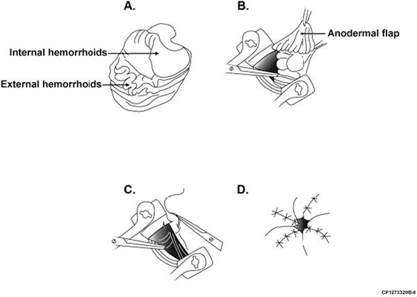 “Total” Hemorrhoidectomy: The Whitehead Hemorrhoidectomy and ...