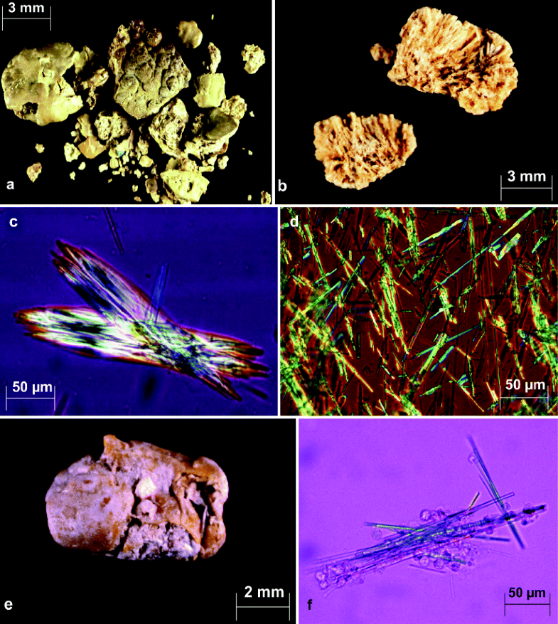 Drug-Induced Renal Stones | SpringerLink