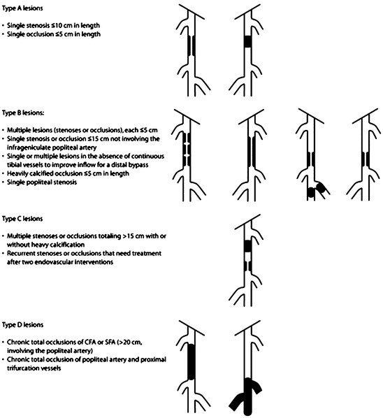 Angioplasty and Stenting of the Superficial Femoral Artery and ...